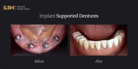 Implant Supported Dentures Dental Implants Kelowna Dental Centre
