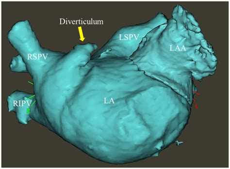 Epicardial Macroreentrant Atrial Tachycardia Involving A Large Left Atrial Roof Diverticulum