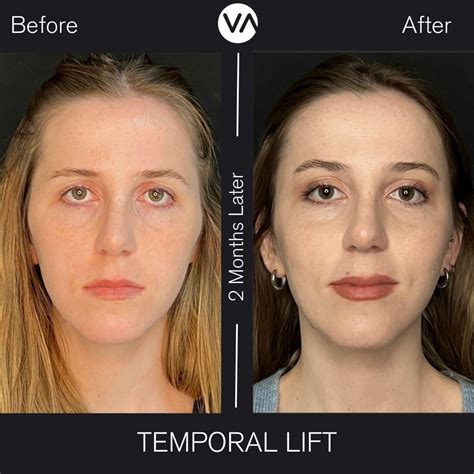 Temporal Lift 2 Months Result Before And After Cosmetic Surgery R