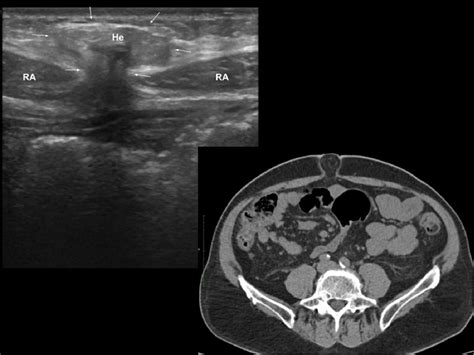 Figure 7 From Dynamic Ultrasound Of Abdominal Wall Hernias Semantic