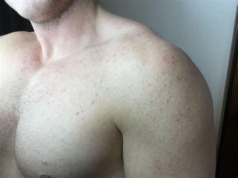 Little red and flesh toned raised bumps all over shoulders, arms, and chest. some on stomach ...
