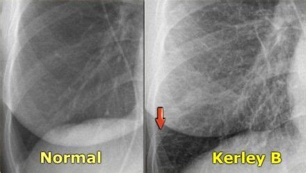 Interstitial Edema Usually Presents As Reticulation Sometimes Kerley B