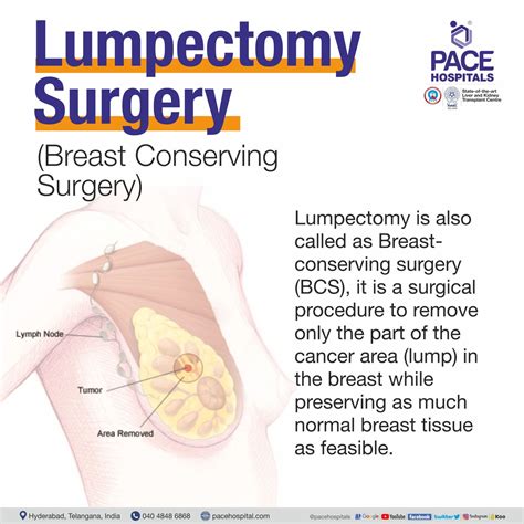 Lumpectomy Breast Conserving Surgery In Hyderabad Recovery And Cost