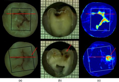 Histological Validation Of Near Infrared Reflectance Multispectral Imaging Technique For Caries