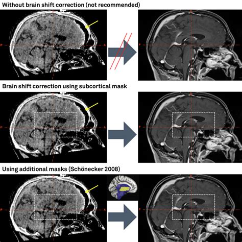 Figure S1 Brain Shift Correction Approach The Top Panel Shows A