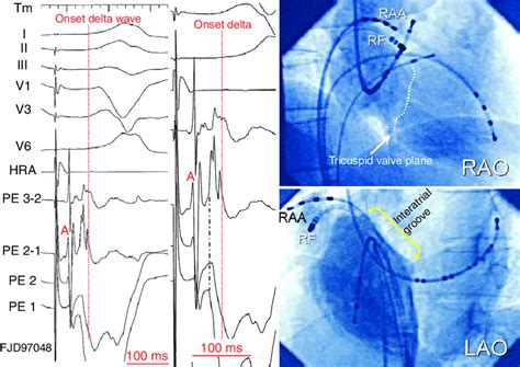 Accessory Pathway Connecting The Right Atrial Appendage With The Right