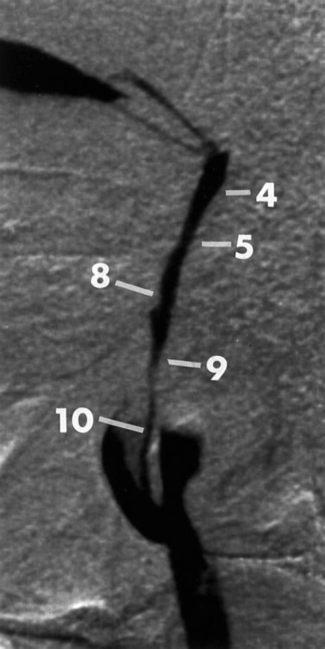 Abscess Of The Lacrimal Sac Due To Chronic Or Subacute Dacryocystitis