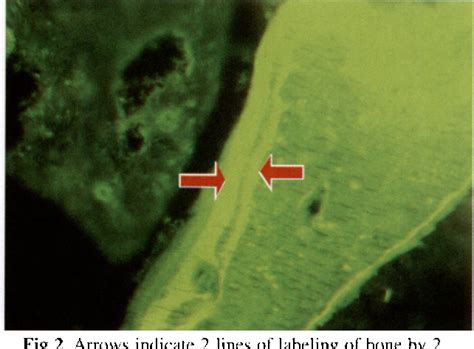 Figure 1 From Pathogenesis Of Chronic Rhinosinusitis Semantic Scholar