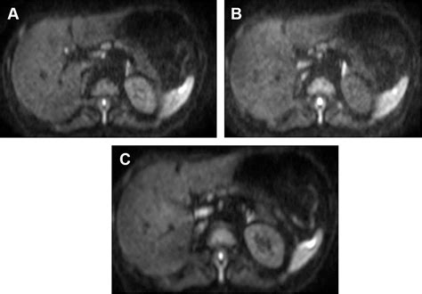 Figure 1 From Multiparametric Mr Imaging In Abdominal Malignancies