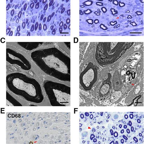 Pathological Alterations In Peripheral Nerves Of Elderly Humans A Download Scientific Diagram