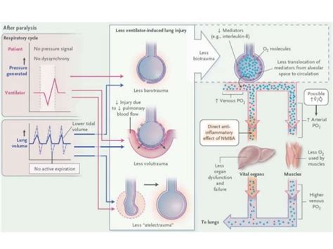 the use of neuromuscular blocking agents in patients with ards copy