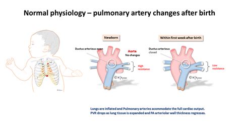 Pda Pathophysiology And Anatomy