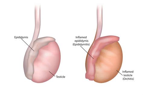 Blue Balls Syndrome Why Is My Left Testicle Bigger Than My Right