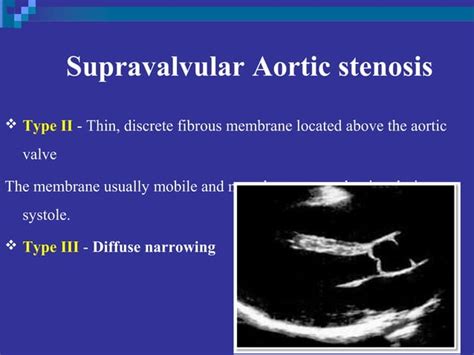 Echo Assessment Of Aortic Valve Disease Dr Ferdous Assistant Registrar