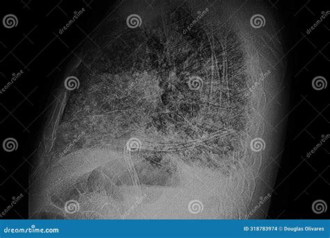 X Ray Image Multiple Small Bilateral Nodular Lesions And Spiculated Image On The Left Lung