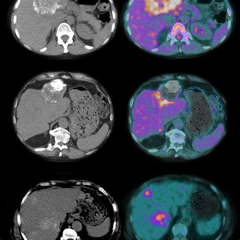 Ae Hepatic Lesion With Typical Macrocalcification At Ct Left And No Download Scientific
