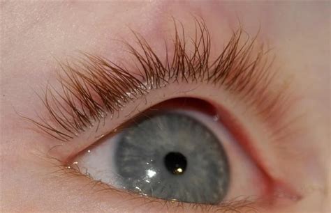 Trichiasis Ingrowing Lashes — Eyesurgicentre