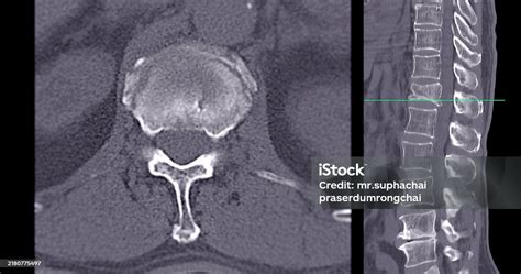 Spinal Compression Fracture At L1 Level Lumbar Ct Scan A Detailed Ct Scan Of The Lumbar Spine Spinal Compression Fracture At L1 Level Lumbar Ct Scan A Detailed Ct Scan Of The Lumbar Spine