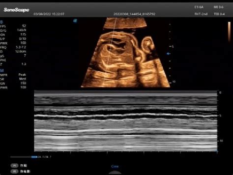 M Mode Echocardiography Showed Decreased And Flat Left Ventricular Wall
