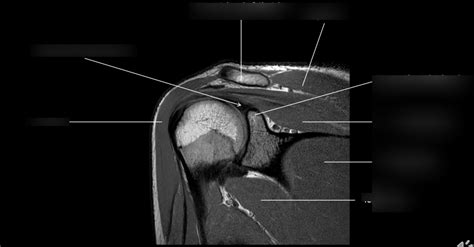 Mri Axial Slice Of Scapula Diagram Quizlet