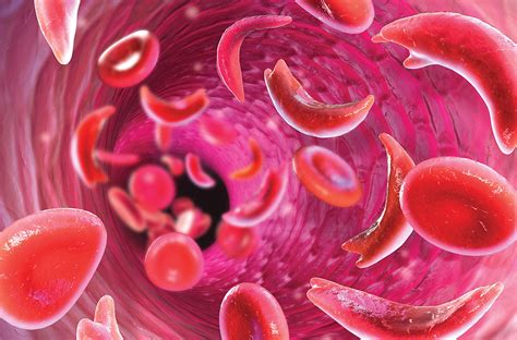 Essential Strategies And Tactics For Managing Sickle Cell Disease Mdedge
