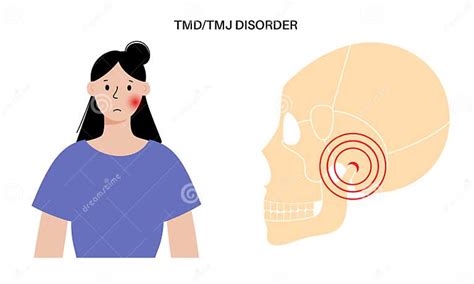Tmd Tmj Disorder Stock Vector Illustration Of Disk 283536432