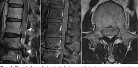 Figure 1 From Redundant Nerve Root Syndrome Mimicking An Intradural