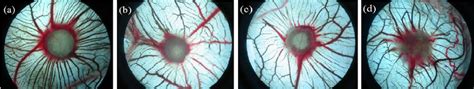 Microvascular Proliferation Of S Ca On Cam ×50 A Blank Control