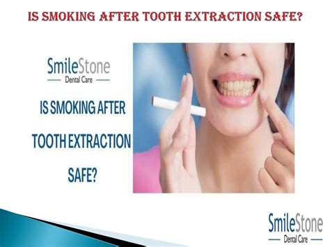 Surgical Tooth Extraction Smoking At Ruby Vannatter Blog