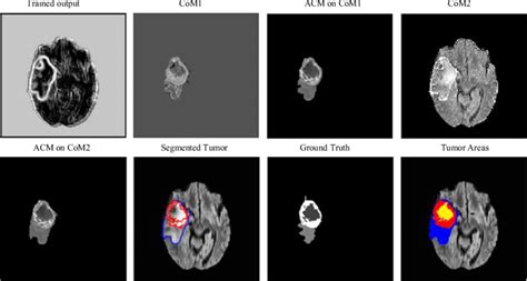 Results Of The Proposed Approach To Segmentation Of Tumour Regions Wt Download Scientific