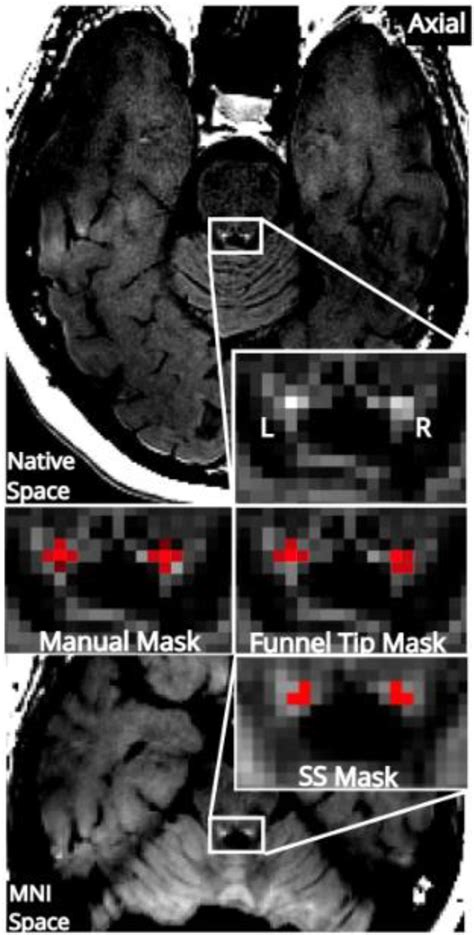 Three Different Locus Coeruleus Lc Segmentation Approaches