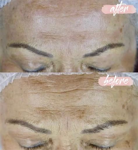 G L Aesthetics Plasma Fibroblast Before And After Results