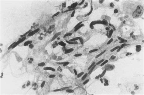 Pleomorphic Recurrent Squamous Cell Carcinoma Scc Cells From A