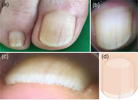 A Fibrillar Transversal Onycholysis Due To Repeated Friction On A