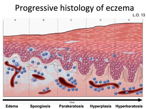 11 22 Dermatitis Flashcards Quizlet