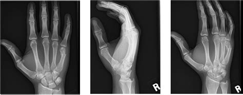 Case Study ORIF Of Th Metacarpal Fracture