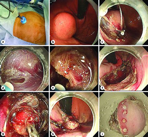 Processes Of Endoscopic Resection With One Port Placement For Gastric Download Scientific