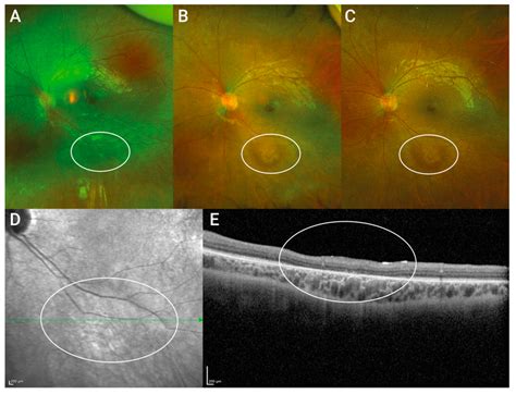 Photoreceptor Layer Loss At The Injection Site Upper Panel Shows