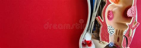 Colon Polyp Removal With Electrical Loop During Colonoscopy Stock Image Image Of Chronic