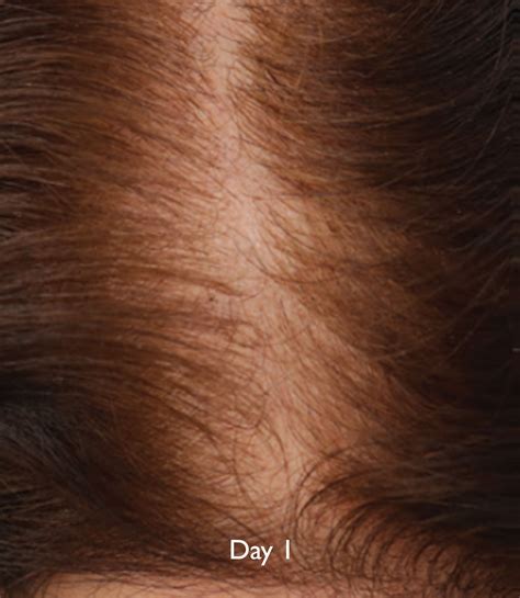 Hair And Scalp Treatment For Women