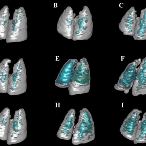 3d Reconstruction Image Of 3d Roi Segmentation Of Lung Ct Images Download Scientific Diagram