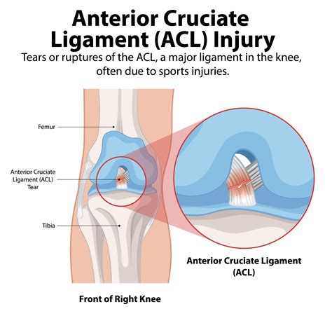 Anterior Cruciate Ligament Acl Injury Symptoms And Treatment Options