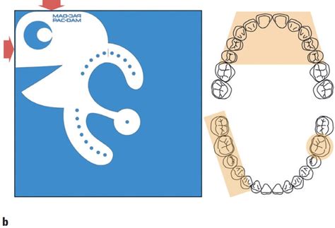 Isolation Pocket Dentistry