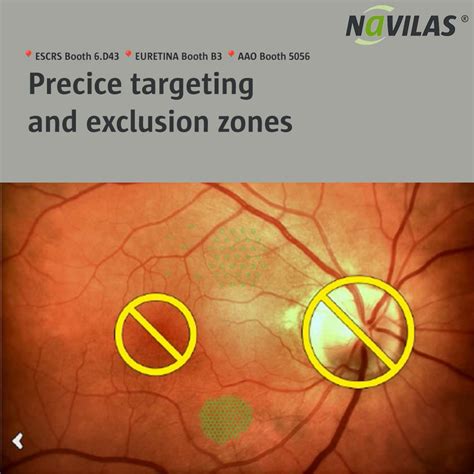 Navilas Retinacare Ophthalmology Eyehealth Visioncare Healthcaretechnology Lasersystem