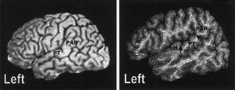 Pars Triangularis Ptr And Pars Opercularis Pop Anatomy The Ptr And Download Scientific