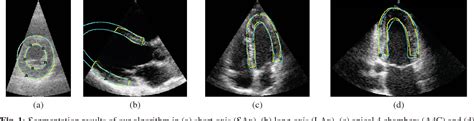 Figure From Multiview Myocardial Segmentation In Echocardiographic Images Using A Piecewise