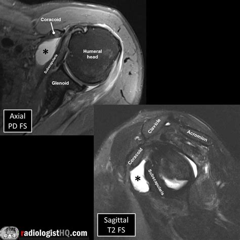 Subcoracoid Bursitis On Mri R Radiology