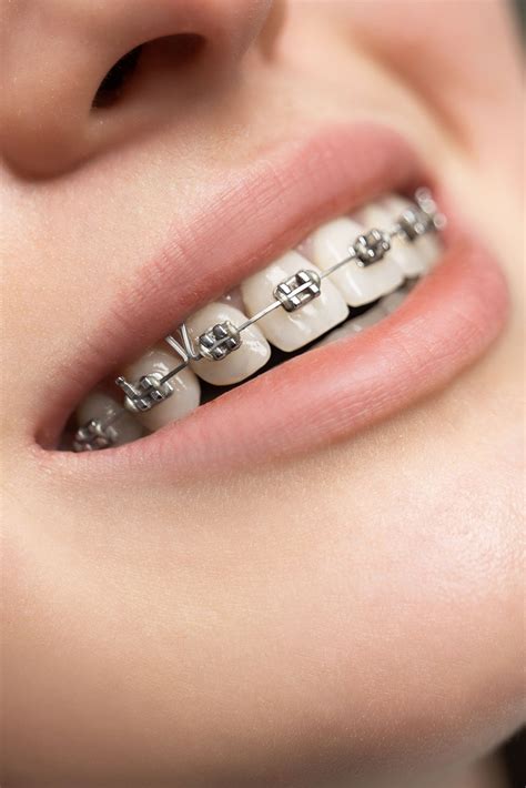 Metal Braces West County Orthodontics Chesterfield Orthodontist