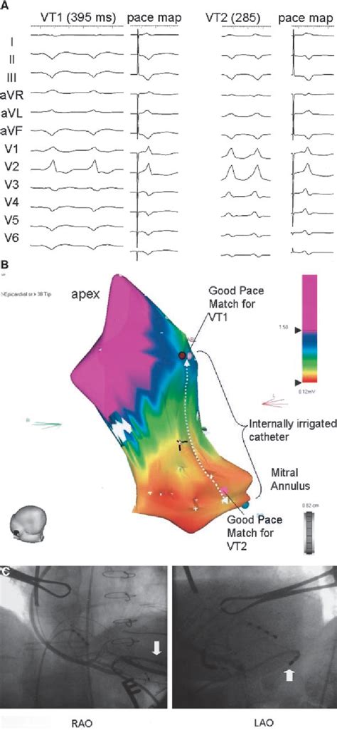 Figure 1 From Subxiphoid Surgical Approach For Epicardial Catheter Based Mapping And Ablation In