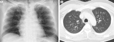 A Chest X Ray On Day 1 Revealed Multiple Lung Cysts B Chest Ct